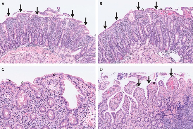A Man with Chronic Diarrhea and Autoimmune Enteropathy | NEJM Resident 360