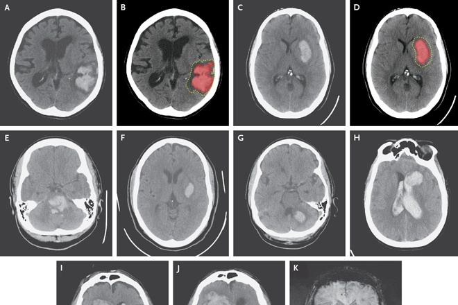 Intracranial Hemorrhage | NEJM Resident 360