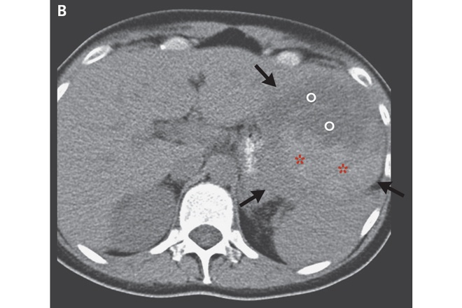A Woman with Postpartum Abdominal Pain and Fever | NEJM Resident 360