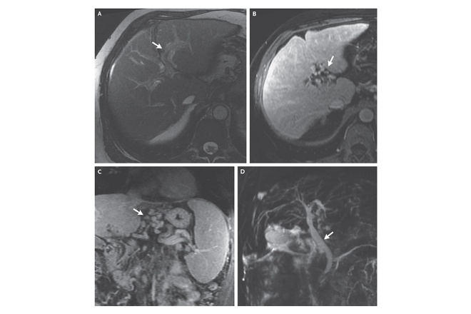 A Man with Abnormal Results on Liver Testing | NEJM Resident 360
