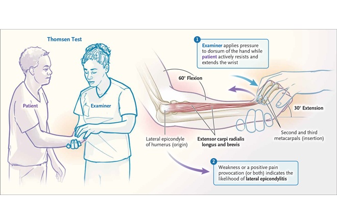 Lateral Epicondylitis Nejm Resident 360