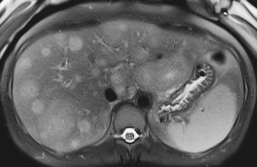 A Pregnant Woman with Newly Diagnosed Adenocarcinoma | NEJM Resident 360