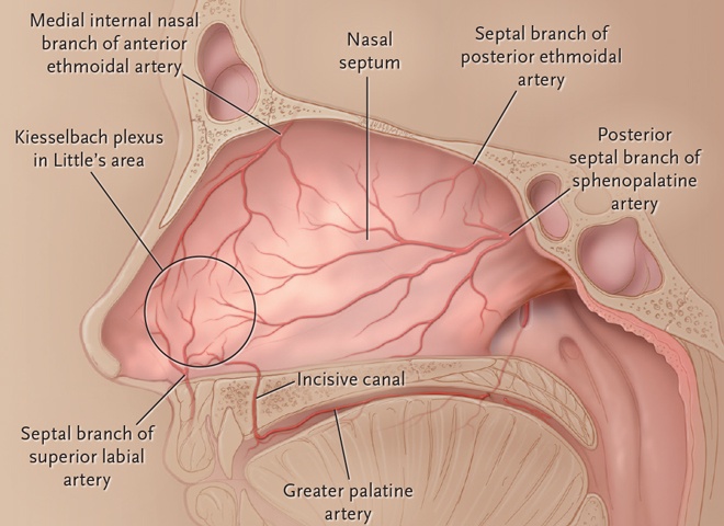 Epistaxis Nejm Resident 360
