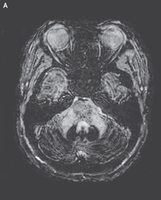 A Woman with Type 1 Diabetes Mellitus and Obtundation | NEJM Resident 360