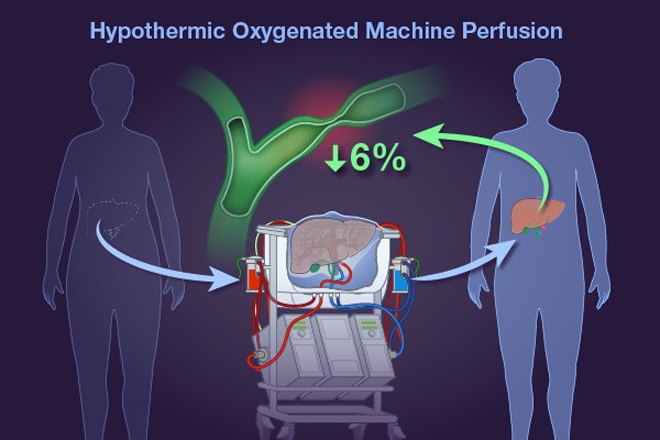Hypothermic Machine Perfusion in Liver Transplantation | NEJM Resident 360