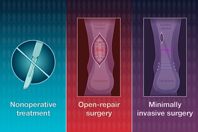 Treatment of Acute Achilles’ Tendon Rupture | NEJM Resident 360