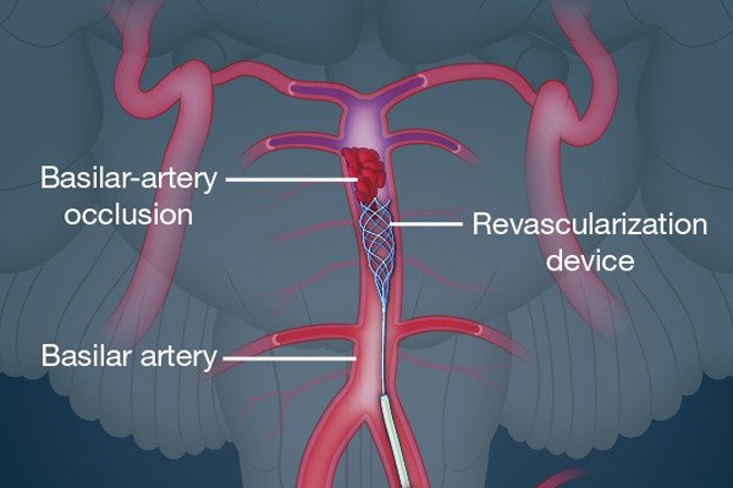 Endovascular Therapy for Basilar-Artery Stroke | NEJM Resident 360
