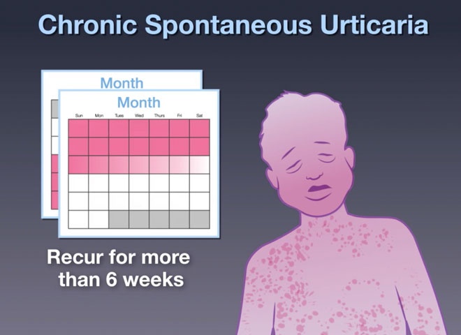 Ligelizumab for Chronic Spontaneous Urticaria | NEJM Resident 360