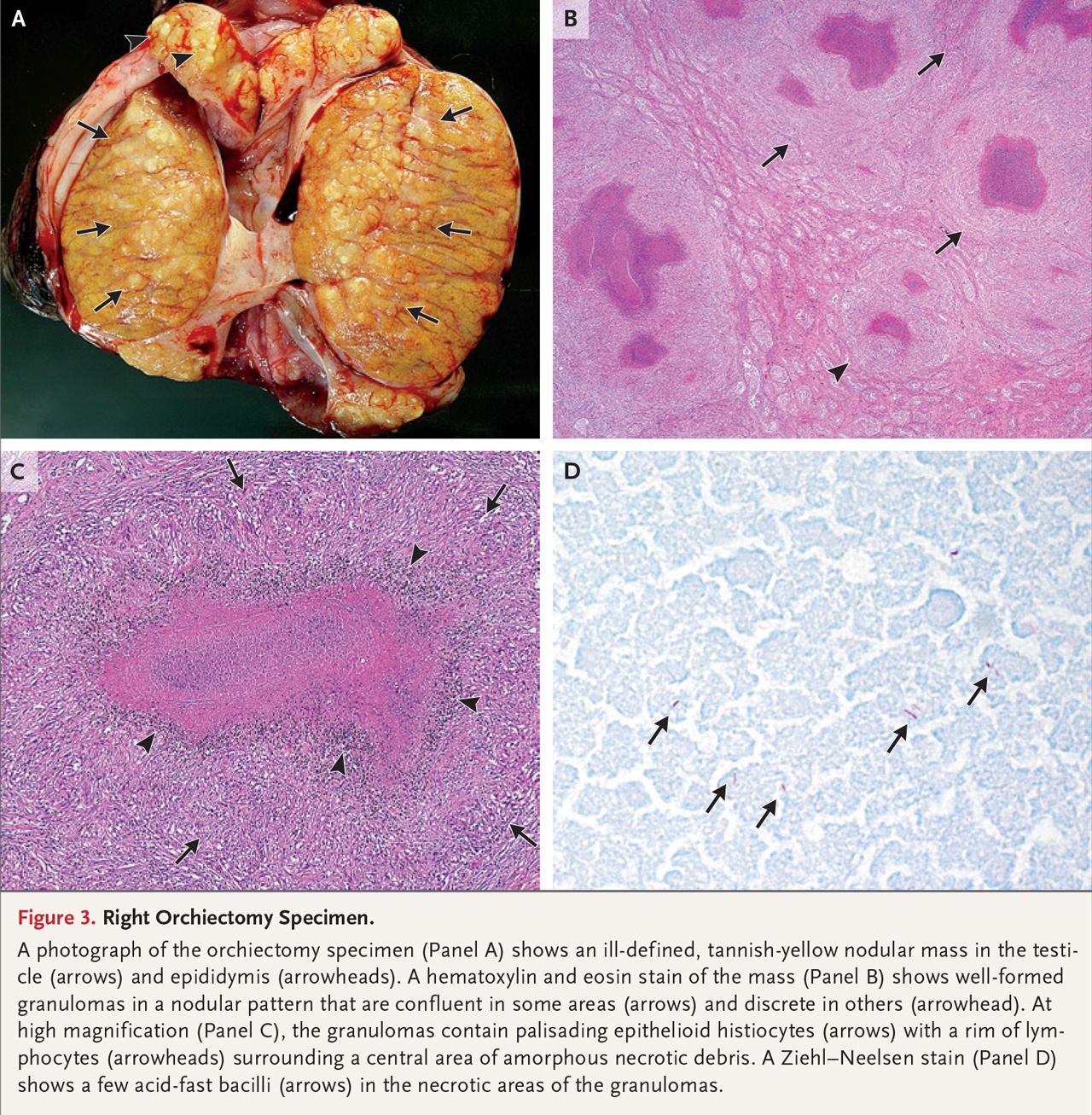 A Man With Unilateral Testicular Swelling Nejm Resident 360