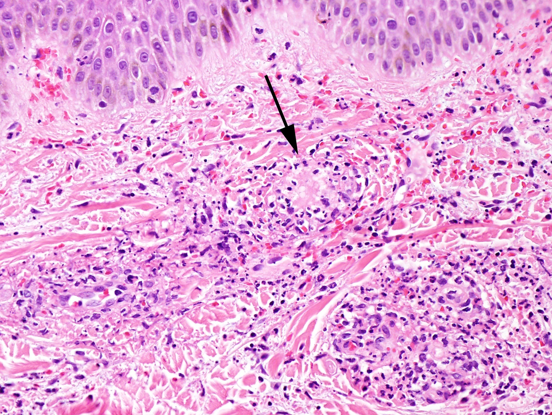 A Man with Swelling of the Calf and a Rash | NEJM Resident 360