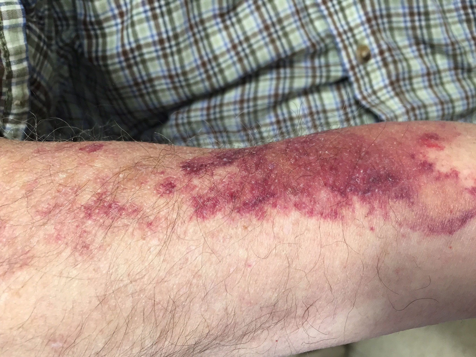 A Man with Leg Weakness, Recurrent Falls, and Anemia | NEJM Resident 360
